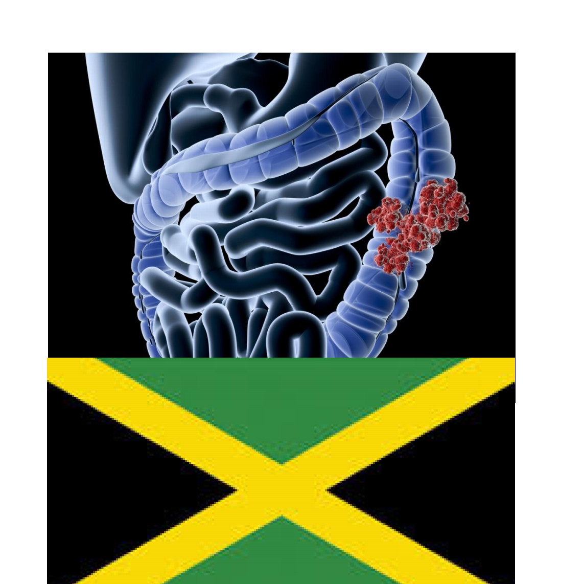 Colorectal cancer increasing in Jamaica - ECS International