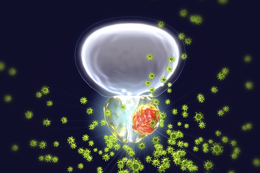Delaying radiation therapy has little effect on survival among prostate ...